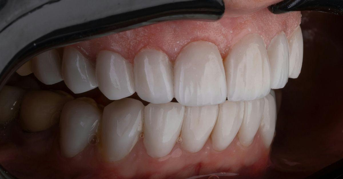 Illuminate Your Dentistry With Dental Loupes With Light