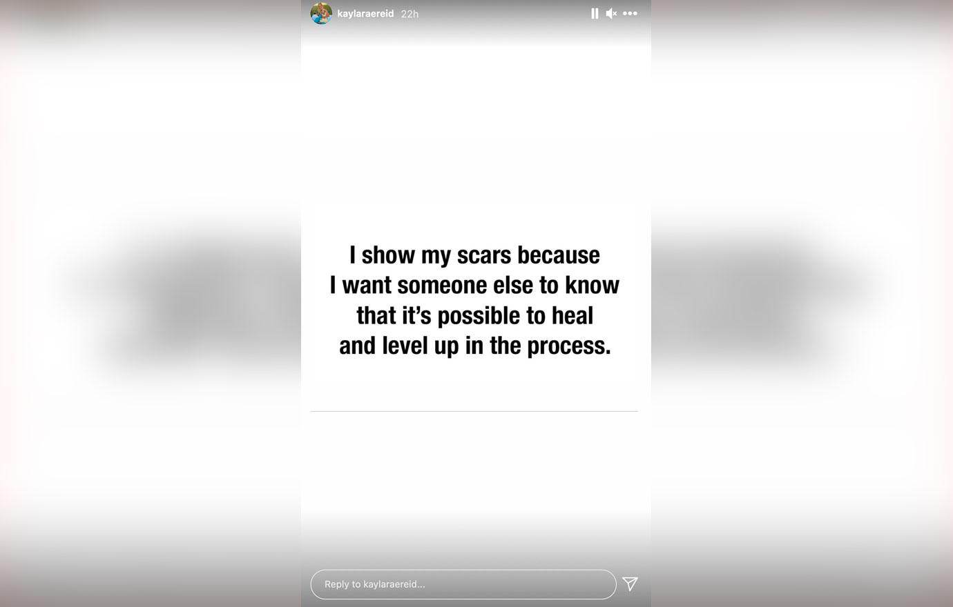 Ryan Lochte's Wife Kayla Rae Reid Shows Breast Implant Removal Scars