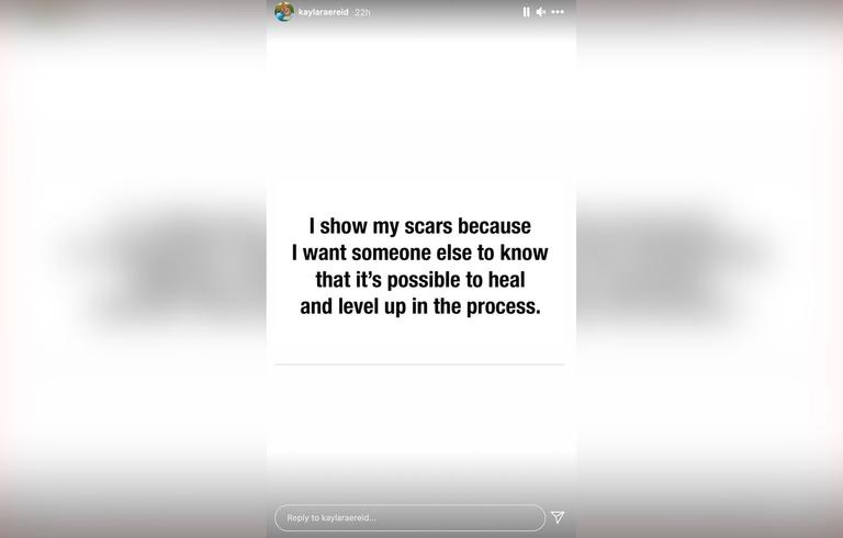 Ryan Lochte's Wife Kayla Rae Reid Shows Breast Implant Removal Scars