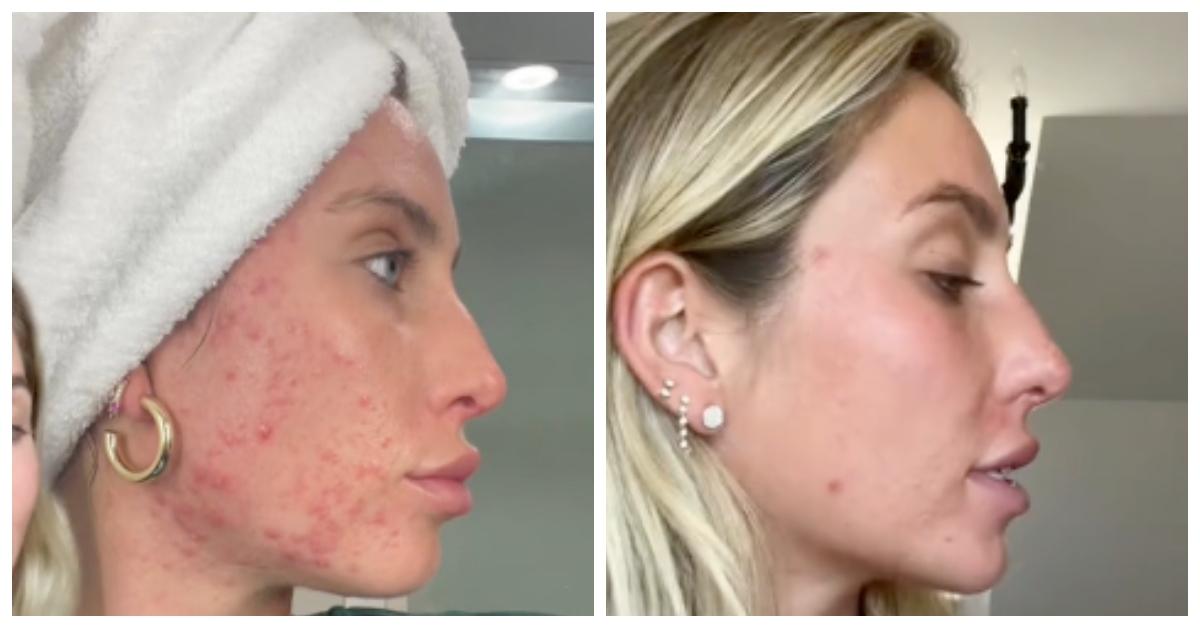 Alix Earle's Acne Journey: Influencer Opens Up About Her Struggles